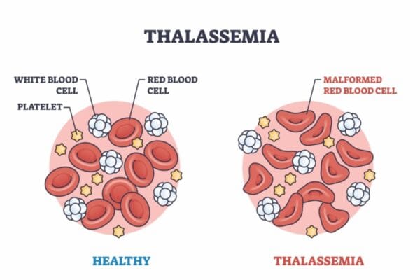 Om Thalassemi. | Medisera